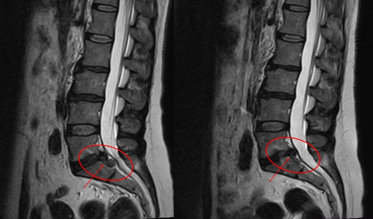 Κήλη μεσοσπονδυλίου δίσκου | Tsanidis Orthopaedics